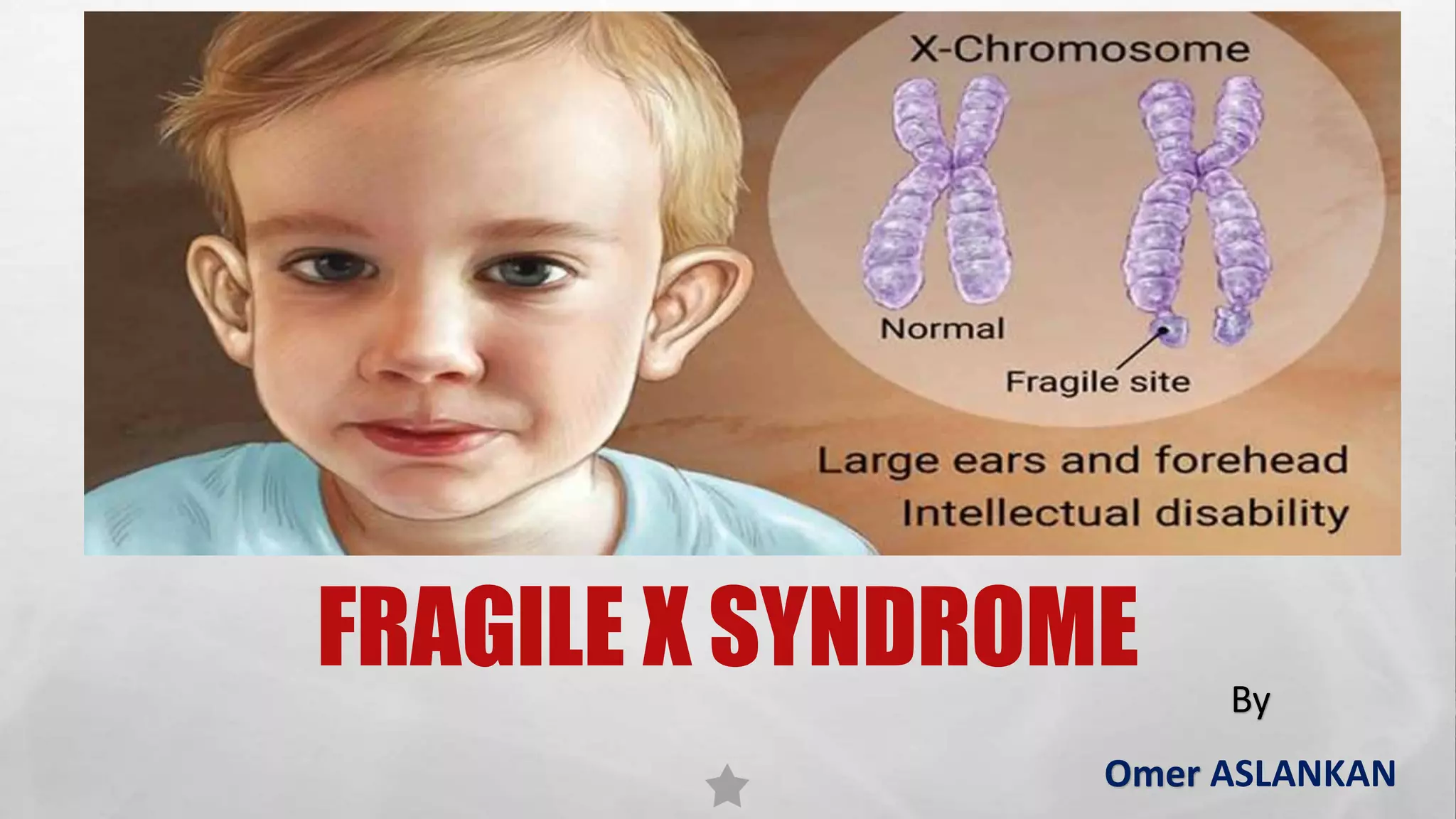 fragile x syndrome.pptx