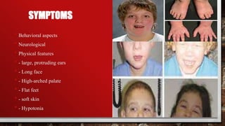 fragile x syndrome.pptx