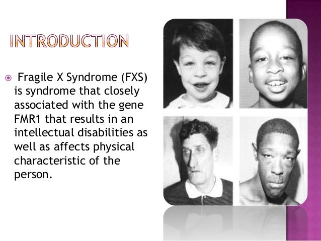 Fragile x syndrome