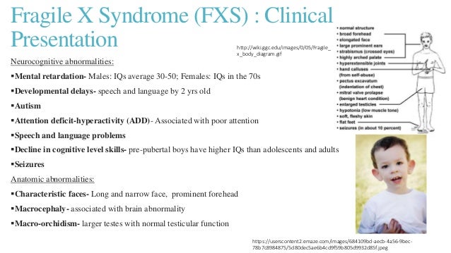 Fragile X Syndrome (FXS)