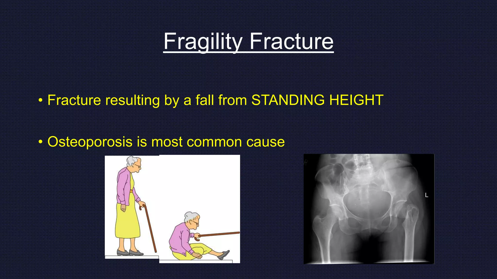 Fragility fractures | PPTX