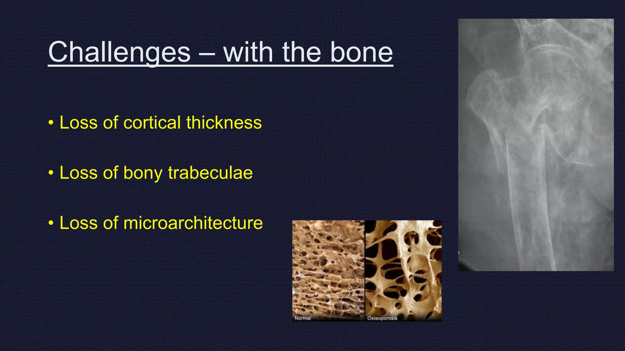 Fragility fractures | PPTX