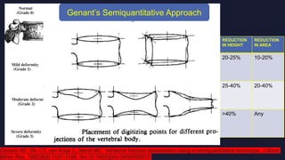 Fragility fractures | PPTX