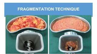 Fragmented Fat Transfer for Massive Weight Loss Gluteal Contouring.pptx