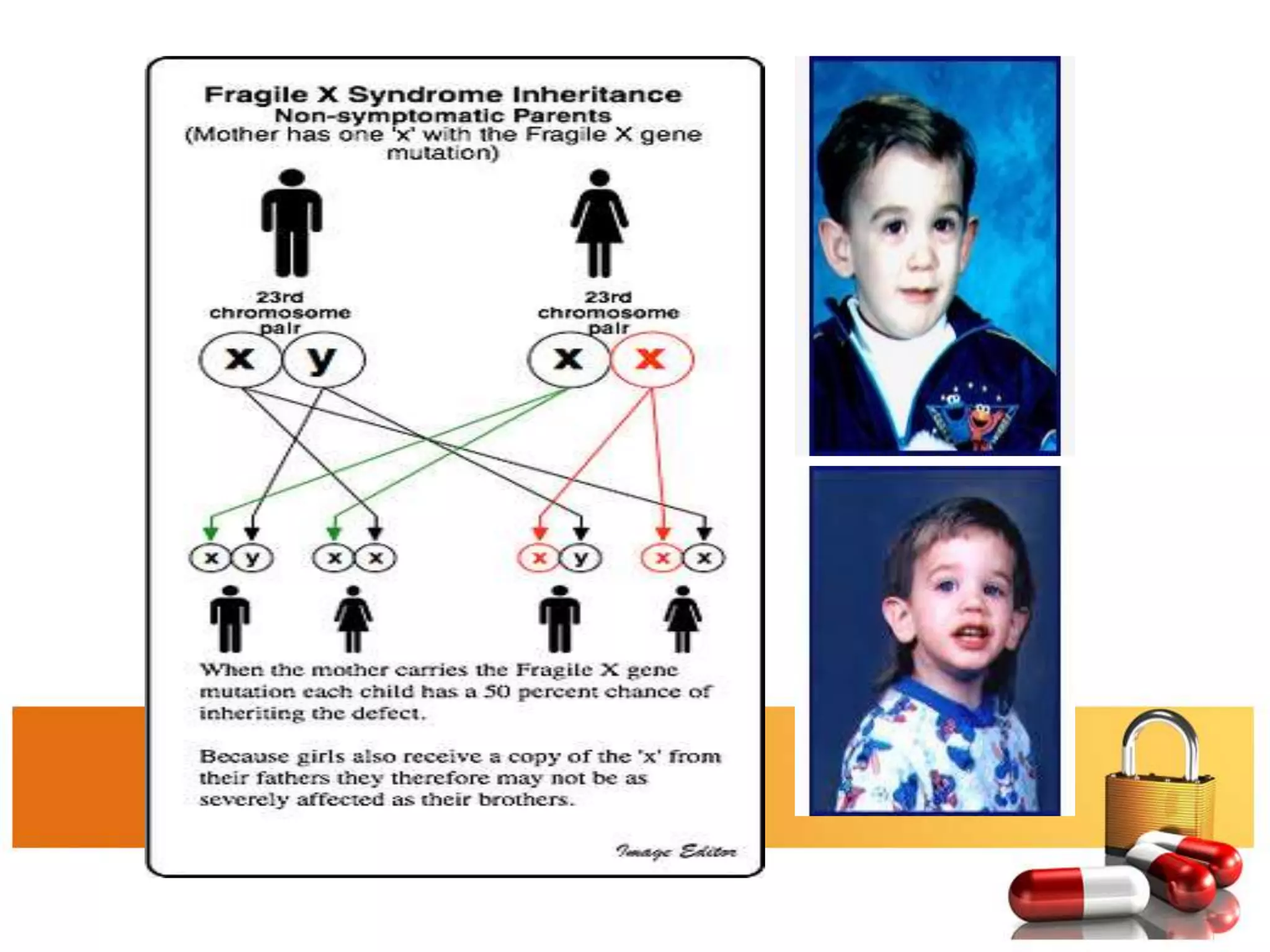 Why Fragile X syndrome | PPTX