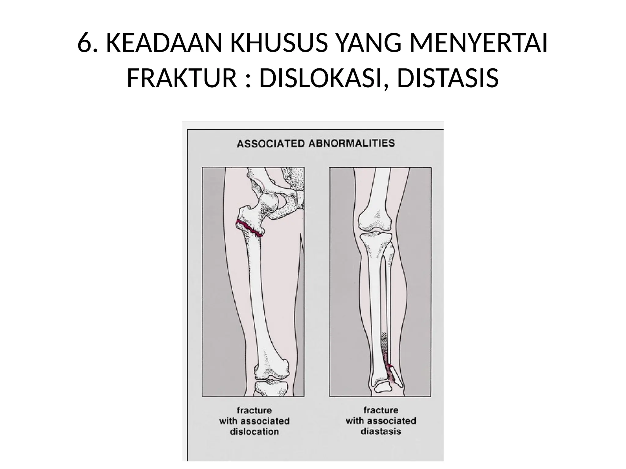 Fraktir tulang: Lokasi anatomi dan perluasan Tipe fraktur Alignment dan ...