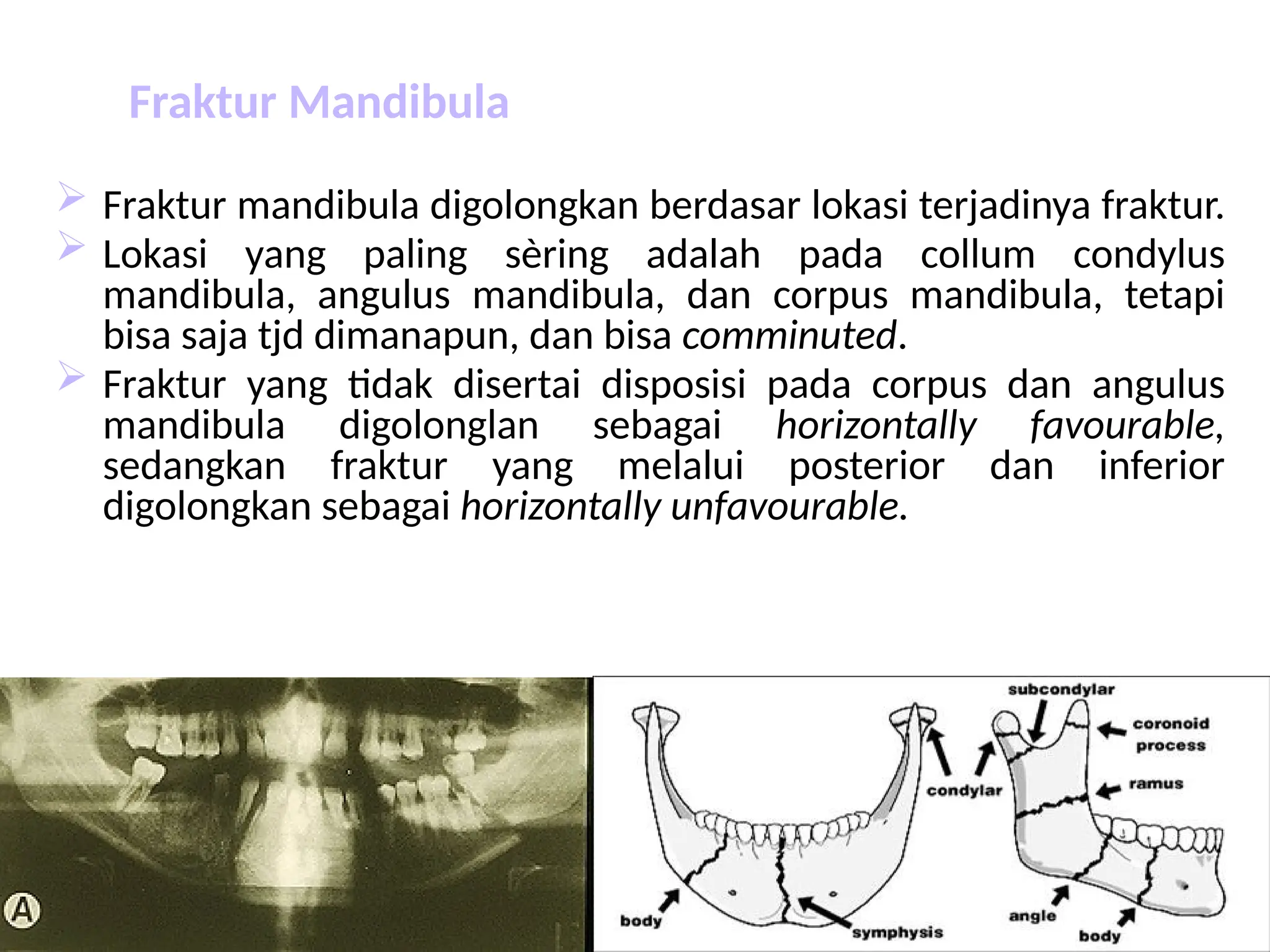Fraktir tulang: Lokasi anatomi dan perluasan Tipe fraktur Alignment dan ...