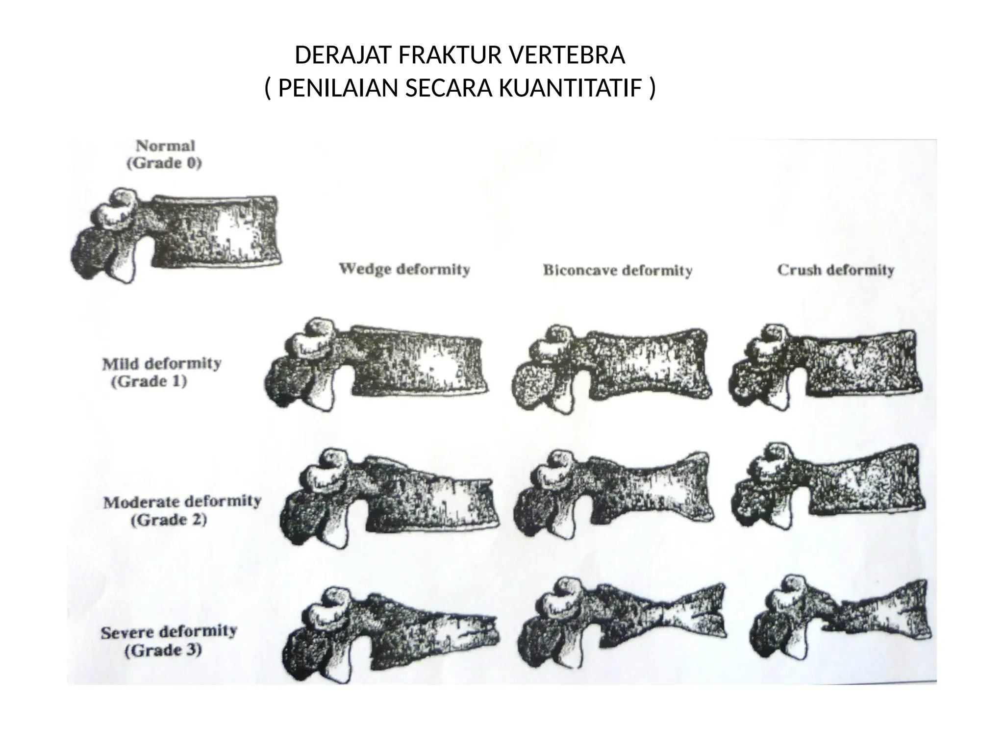 Fraktir tulang: Lokasi anatomi dan perluasan Tipe fraktur Alignment dan ...