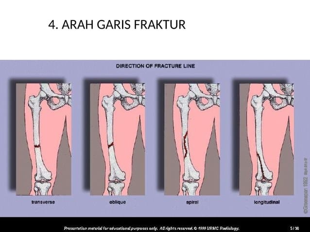 Fraktir tulang: Lokasi anatomi dan perluasan Tipe fraktur Alignment dan ...