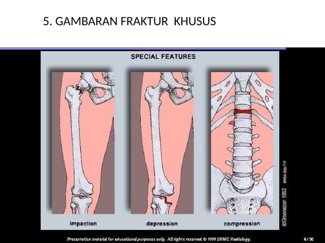 Fraktir tulang: Lokasi anatomi dan perluasan Tipe fraktur Alignment dan ...