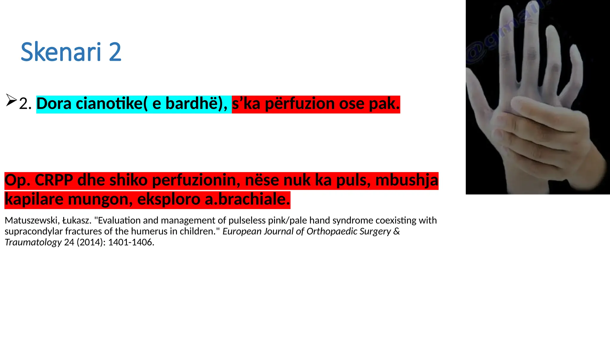 Frakturat suprakondilare te humerusit tek femijet.pptx