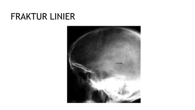 FRAKTUR CALVARIA FOTO WATERS PERBEDAAN OA RA.pptx