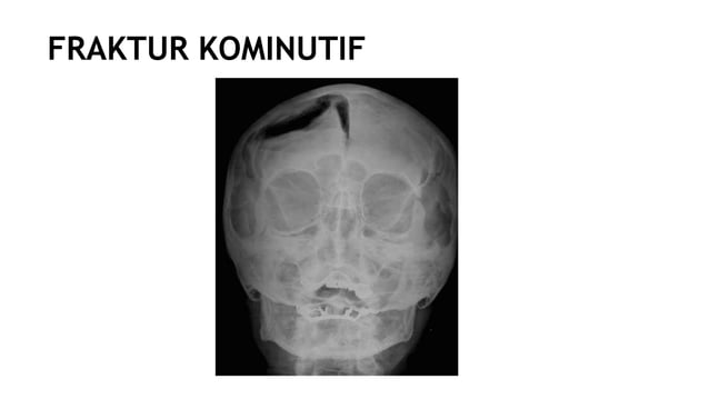 FRAKTUR CALVARIA FOTO WATERS PERBEDAAN OA RA.pptx