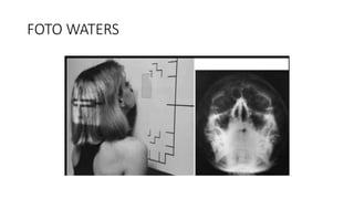 FRAKTUR CALVARIA FOTO WATERS PERBEDAAN OA RA.pptx