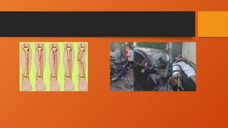 Penanganan Fraktur (Patah Tulang) fix. ppt | PPTX
