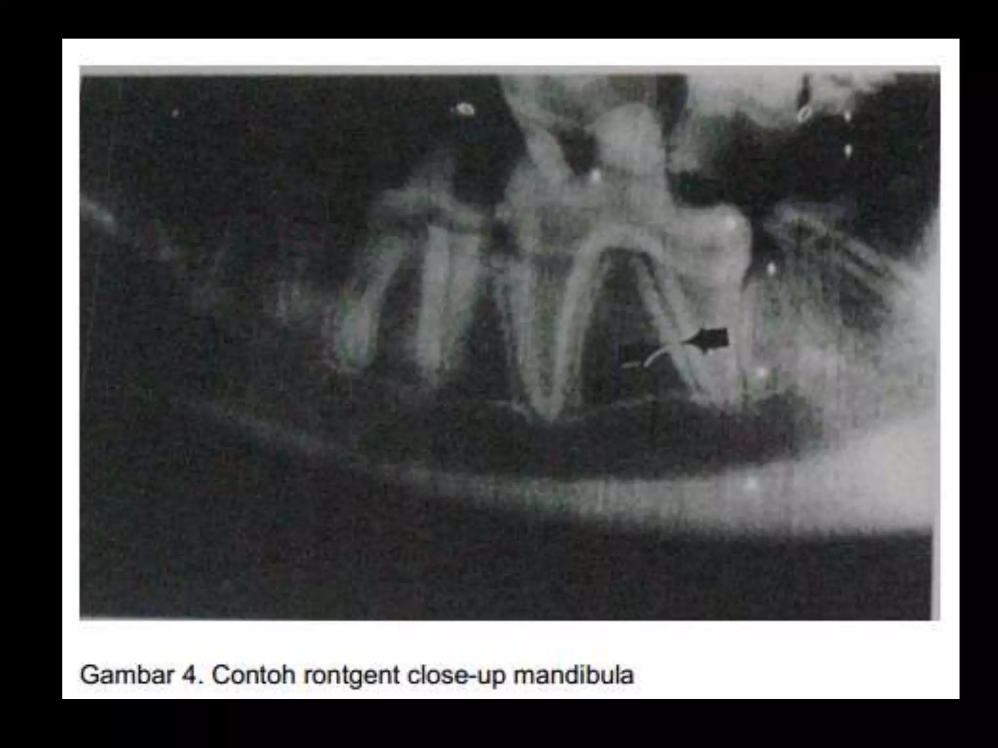 Fraktur mandibula | PPTX