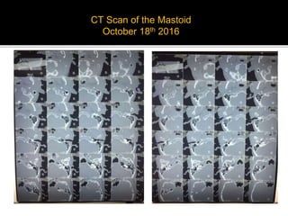 multiple facial fracture | PPTX