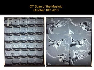 multiple facial fracture | PPTX