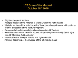 multiple facial fracture | PPTX