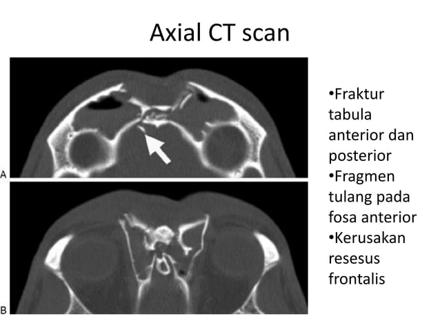 Fraktur sinus frontal | PPT | Free Download