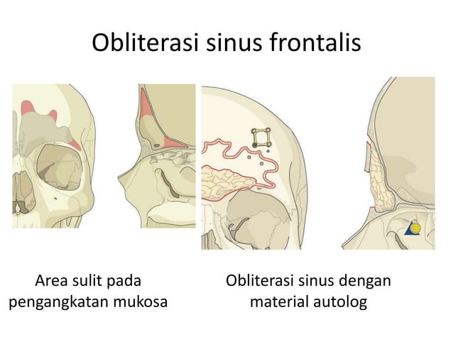 Fraktur sinus frontal | PPT | Free Download