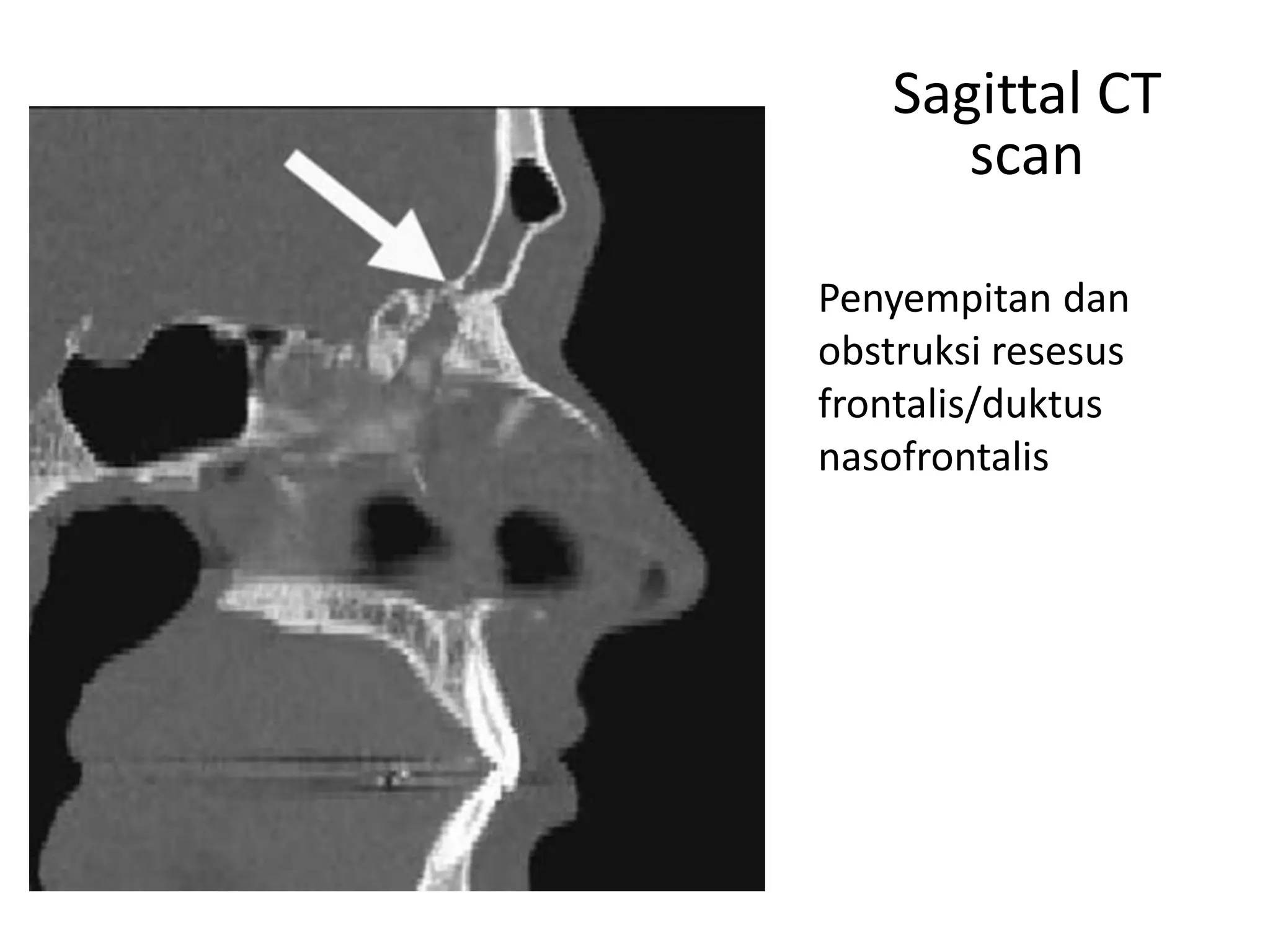 Fraktur sinus frontal | PPTX