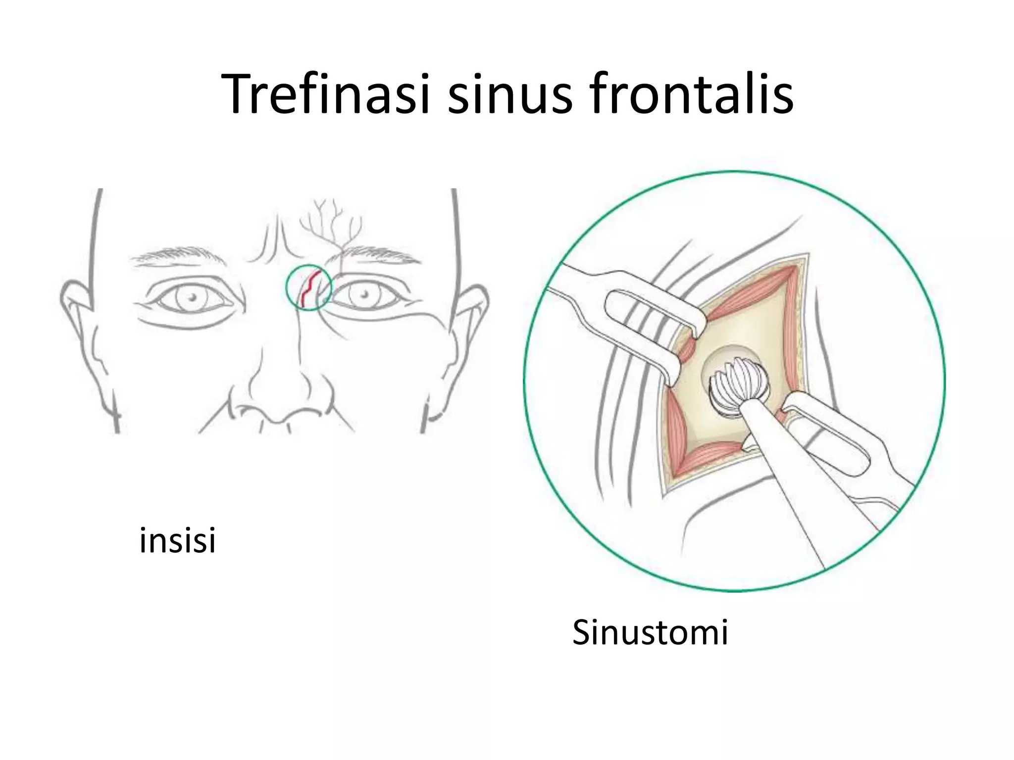 Fraktur sinus frontal | PPTX
