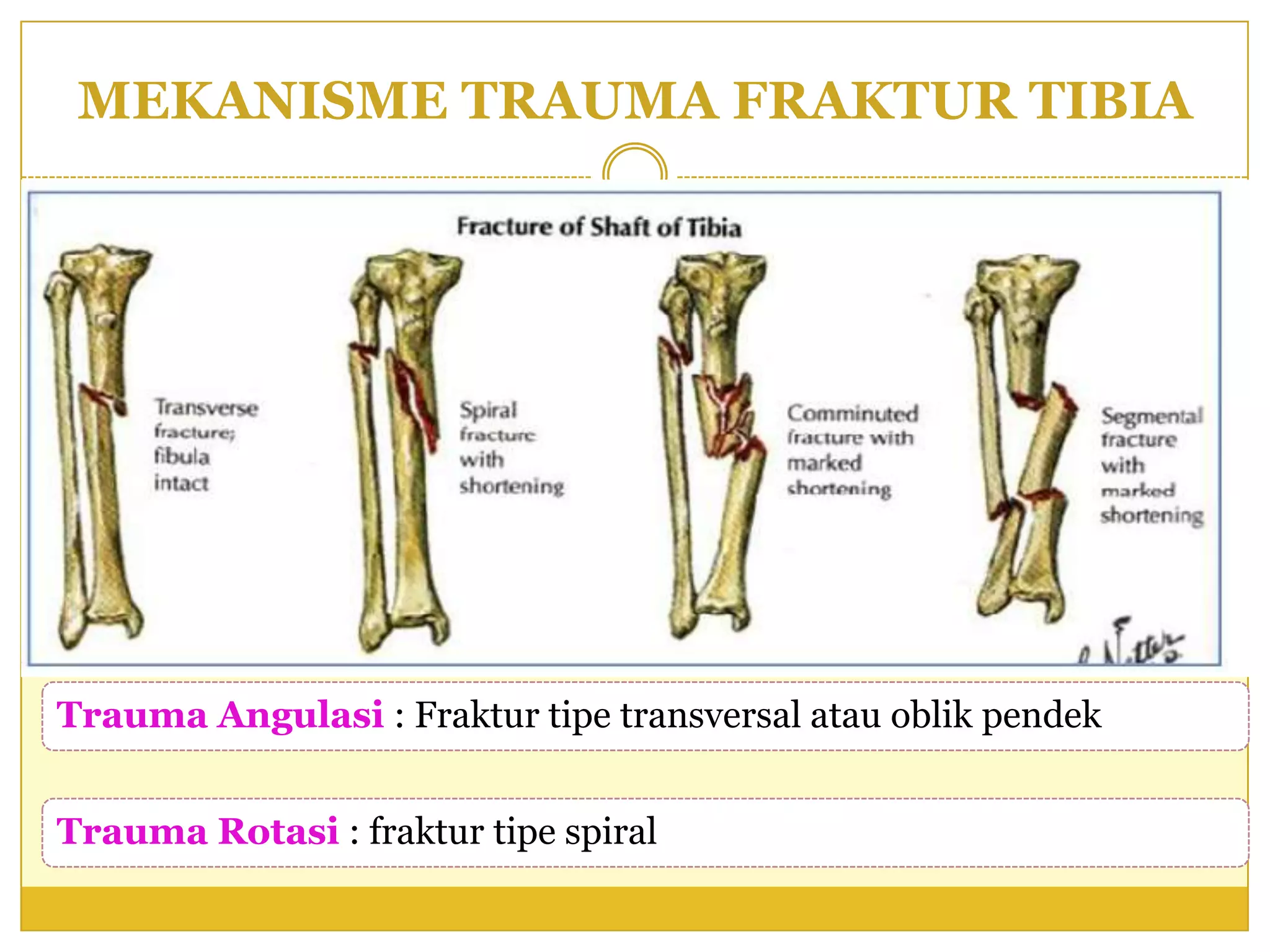 Fraktur tibia | PPTX