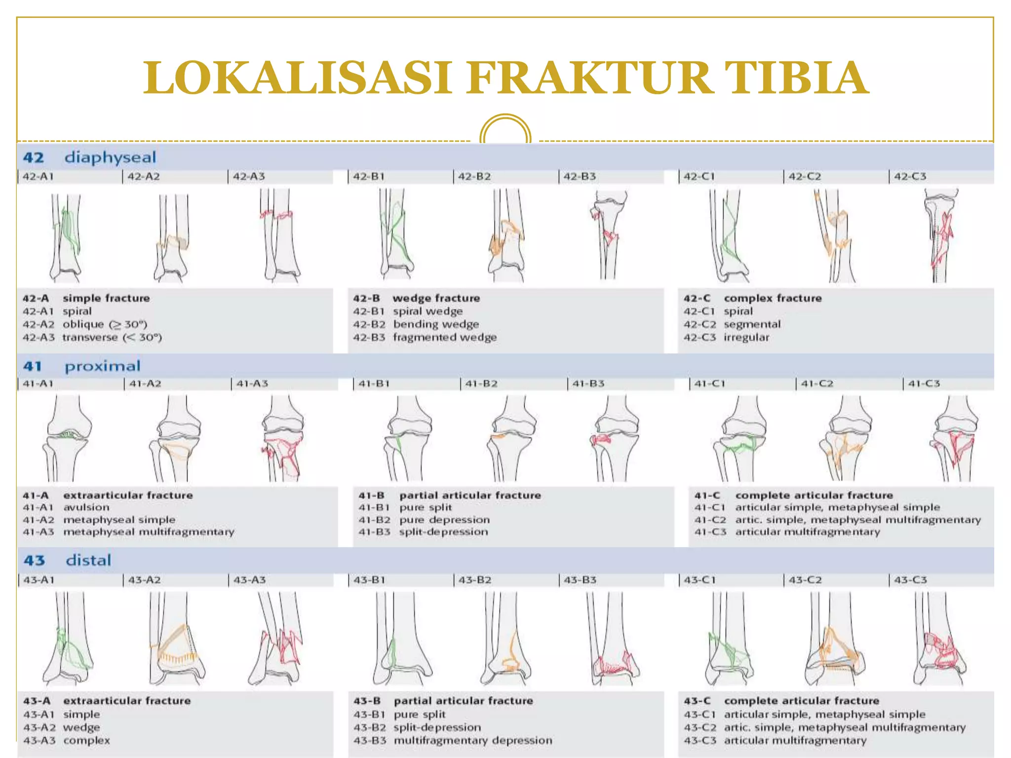 Fraktur tibia | PPTX