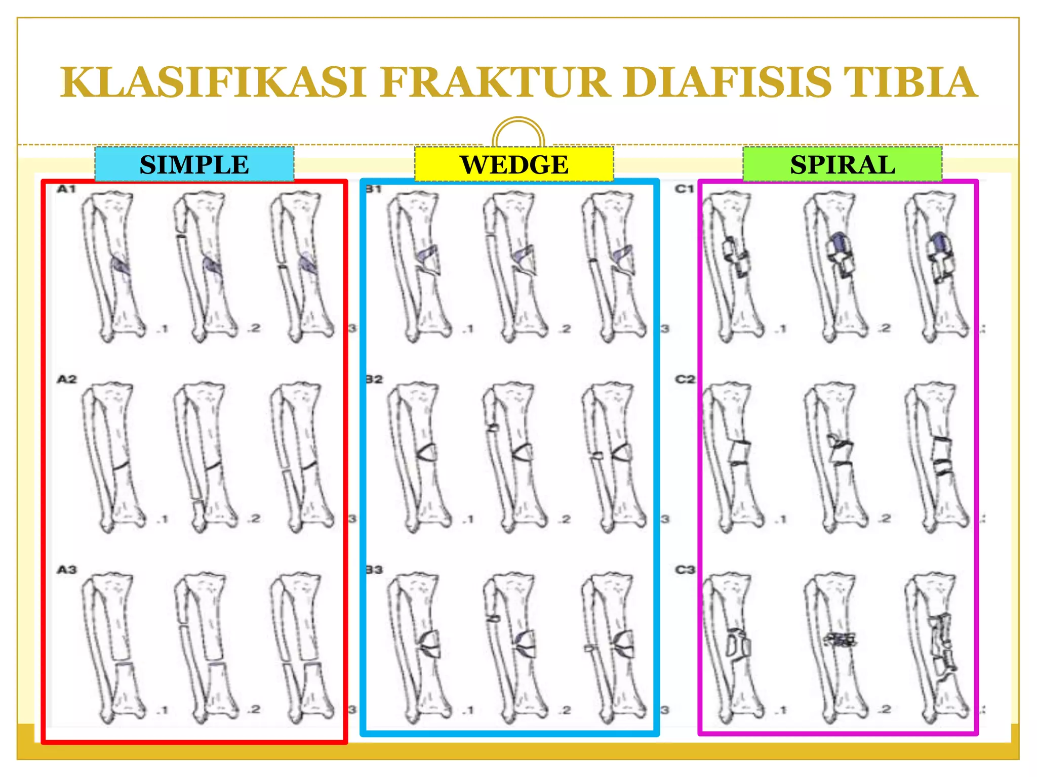 Fraktur tibia | PPTX