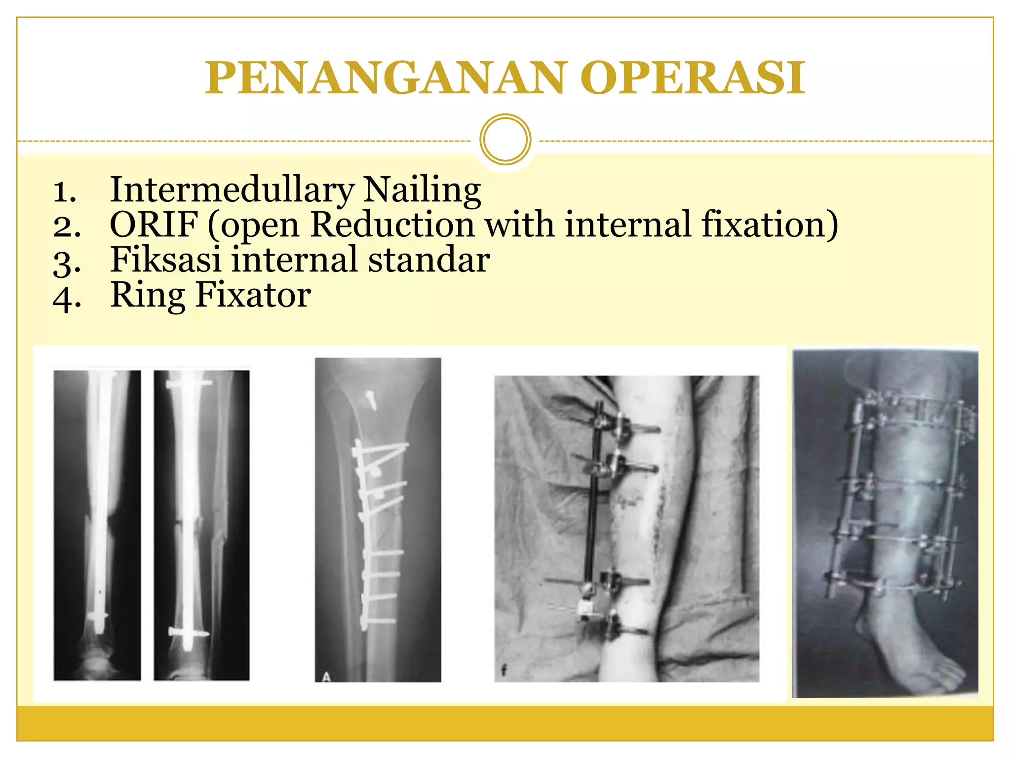 Fraktur tibia | PPTX