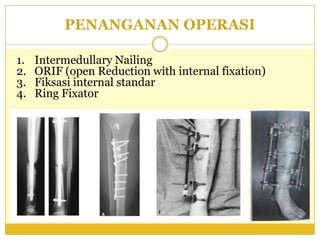 Fraktur tibia | PPTX