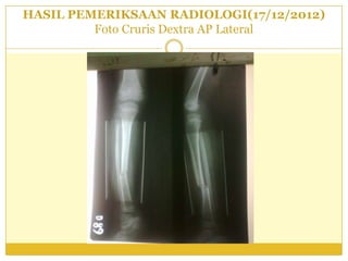 Fraktur tibia | PPTX