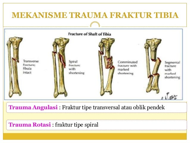 Fraktur tibia