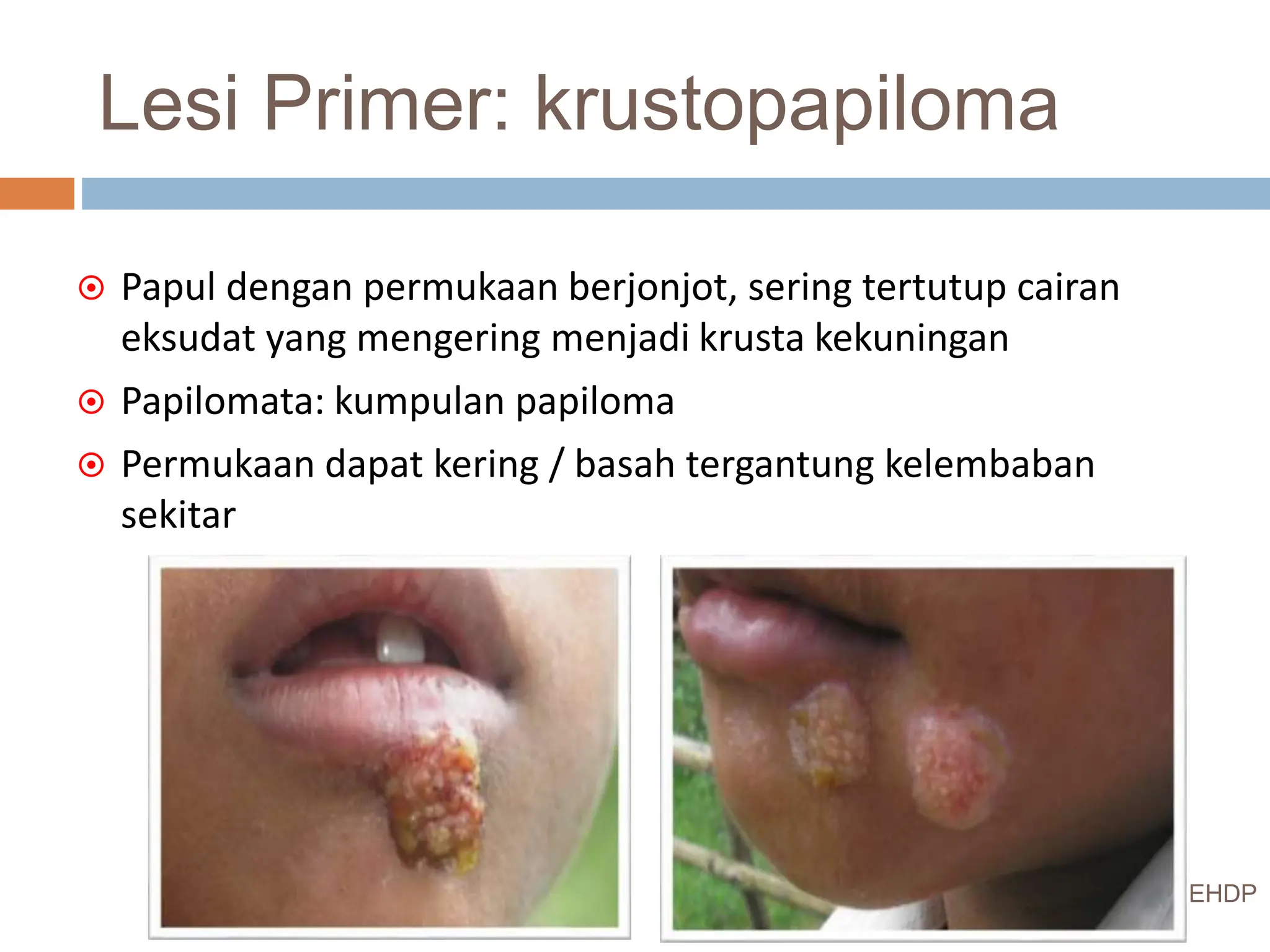Frambusia PPT.pptx