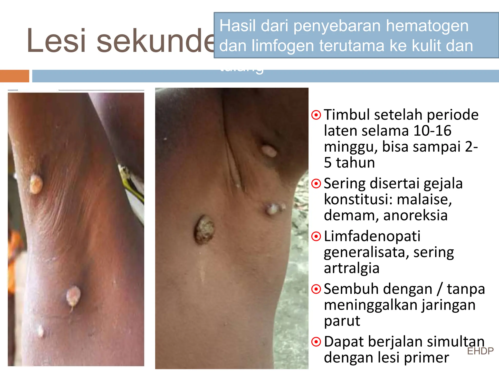 Frambusia PPT.pptx