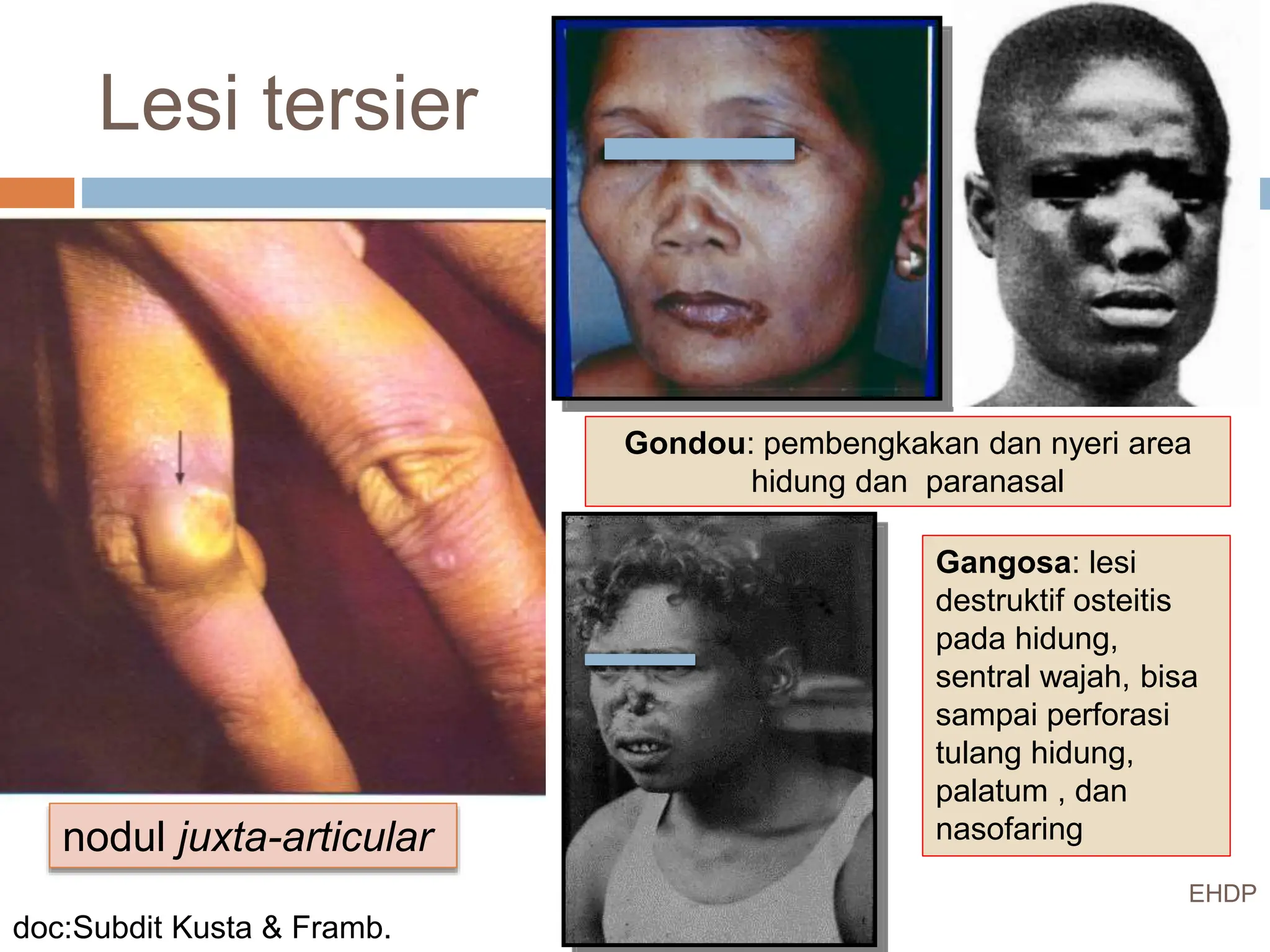 Frambusia PPT.pptx