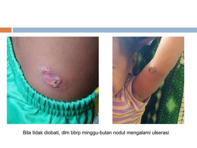 Frambusia PPT.pptx