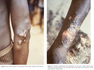 Frambusia PPT.pptx