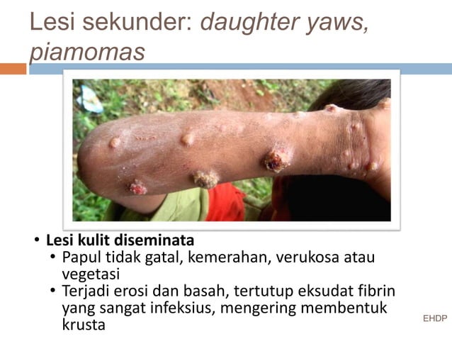 Frambusia PPT.pptx