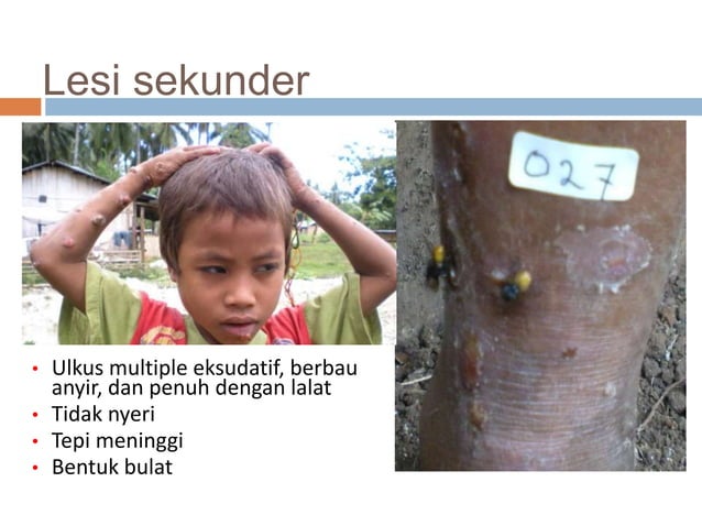 Frambusia PPT.pptx