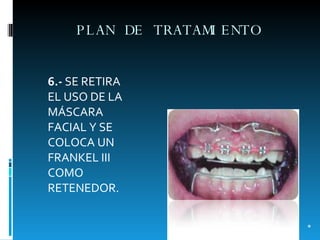 Frankel | PPT