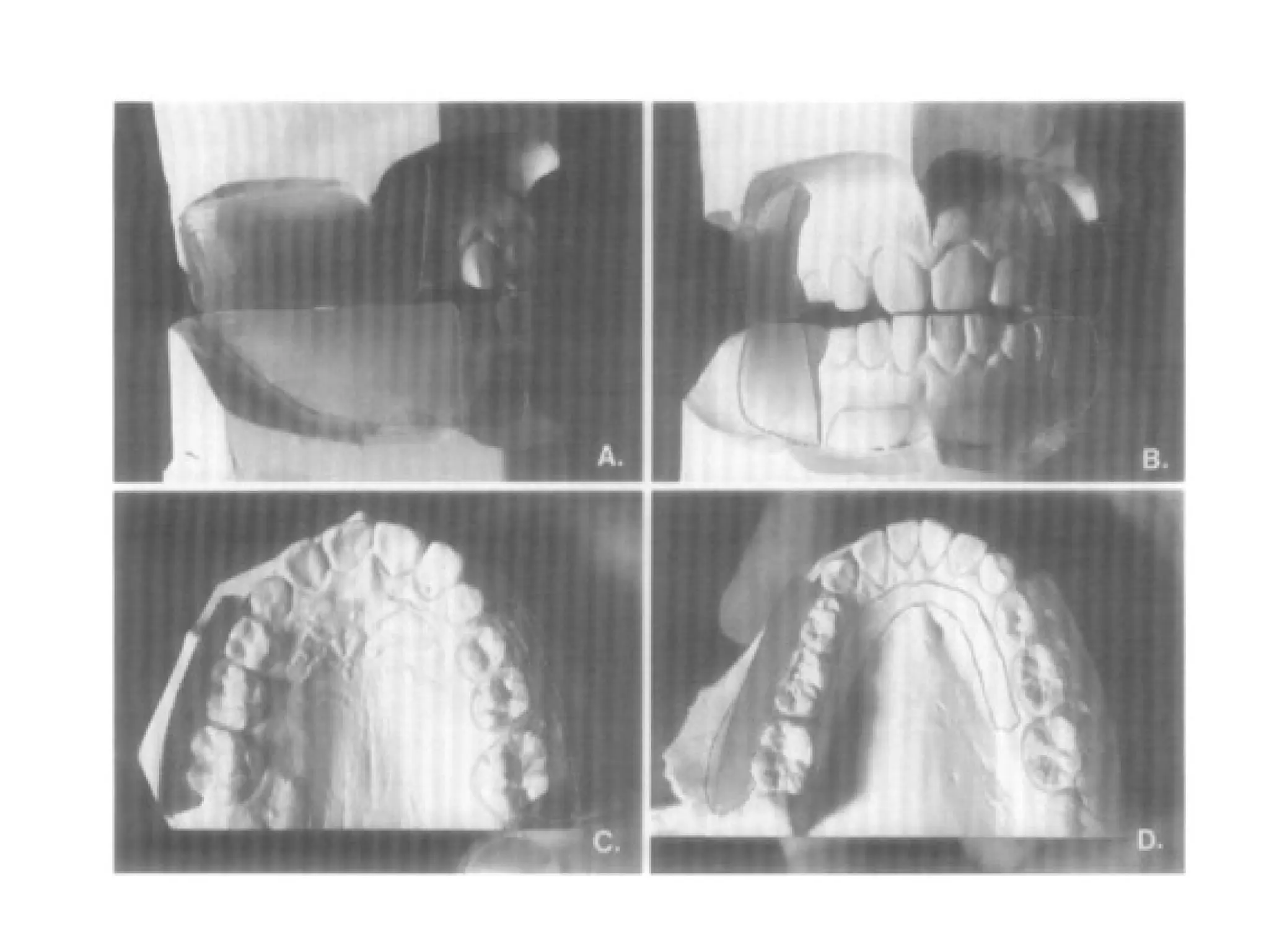 frankel functional regulator orthodontics.pptx