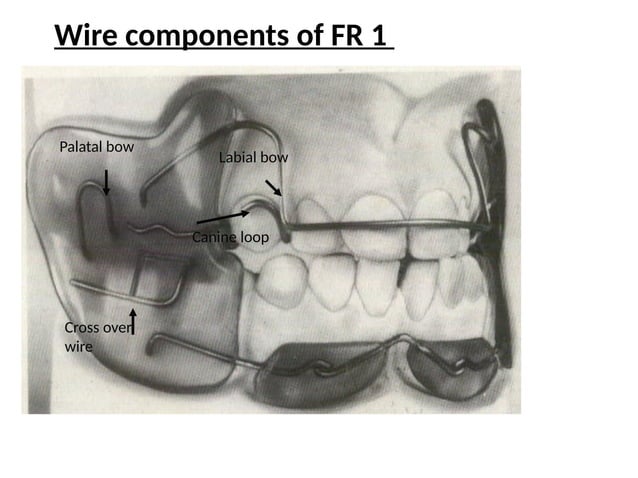 frankel functional regulator orthodontics.pptx