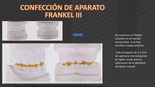 Aparato de ortopedia frankel_III final .pdf