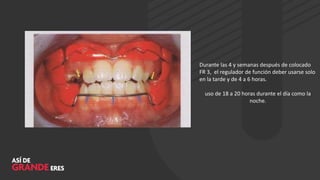 Aparato de ortopedia frankel_III final .pdf