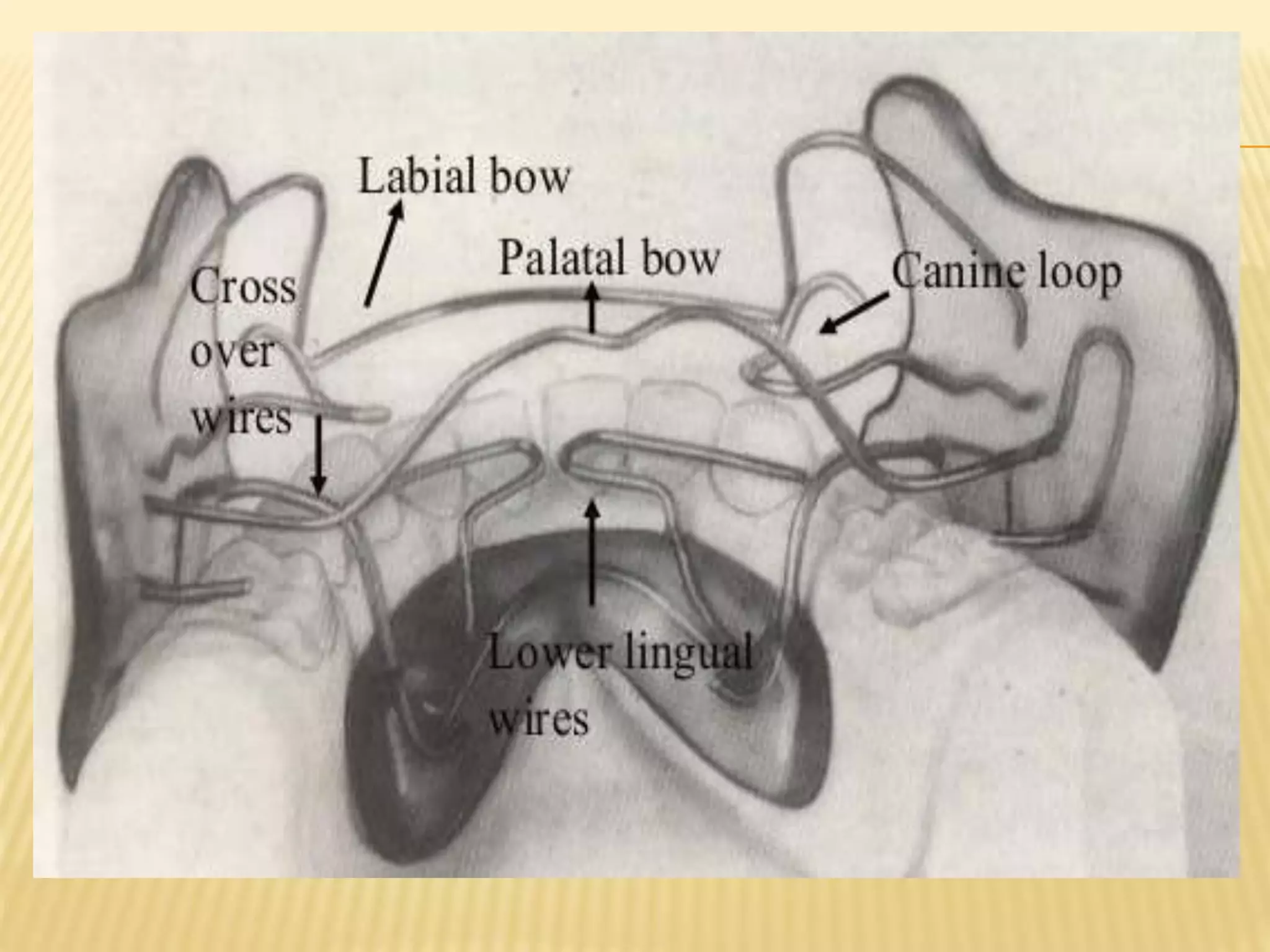 Frankel’s appliance | PPTX