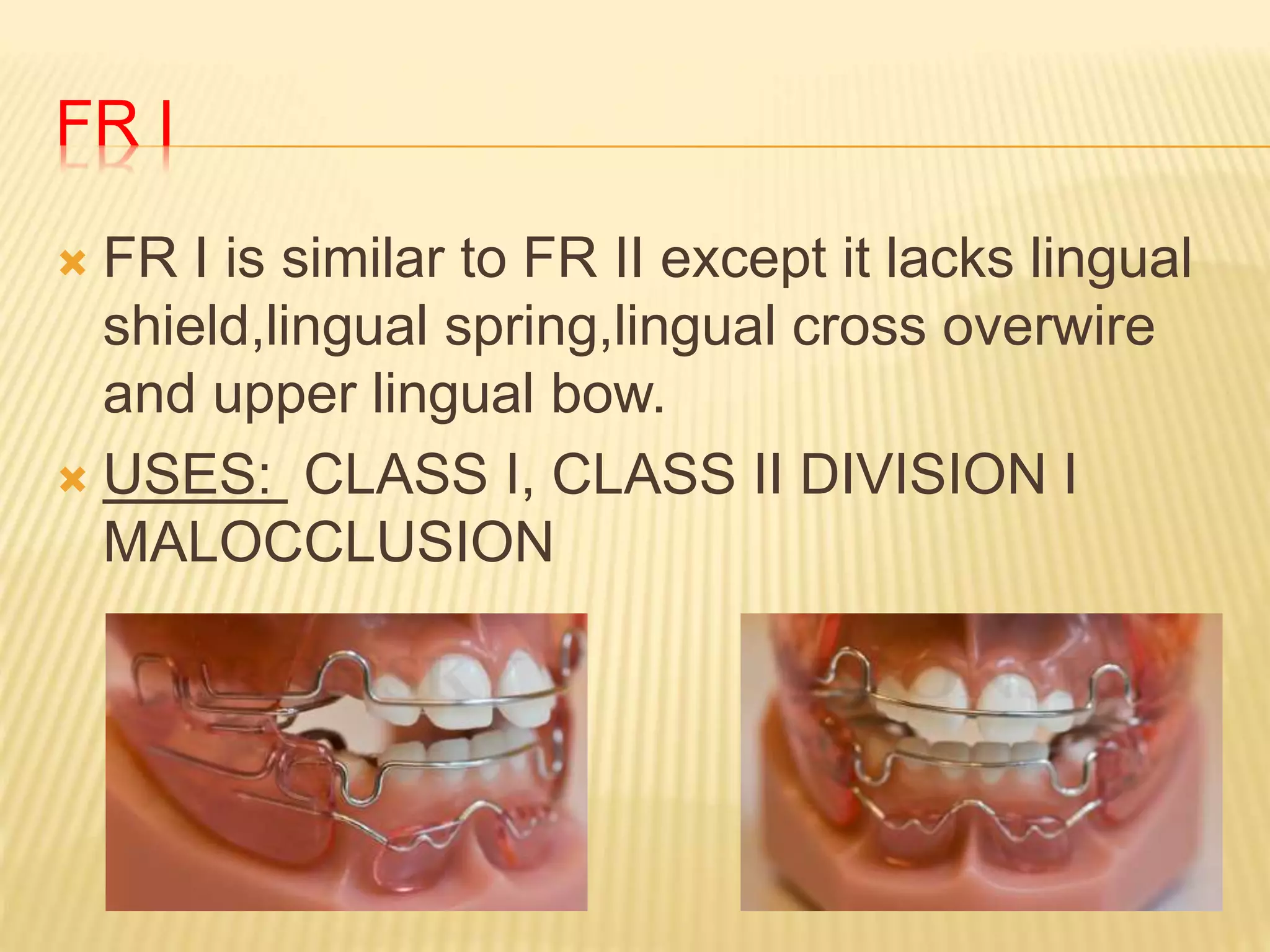 Frankel’s appliance | PPTX
