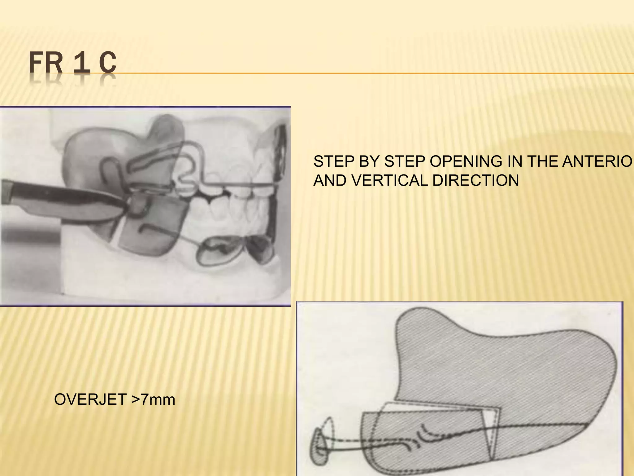 Frankel’s appliance | PPTX