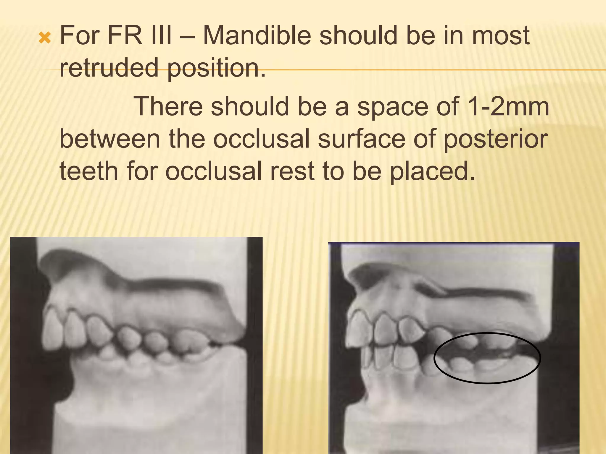 Frankel’s appliance | PPTX